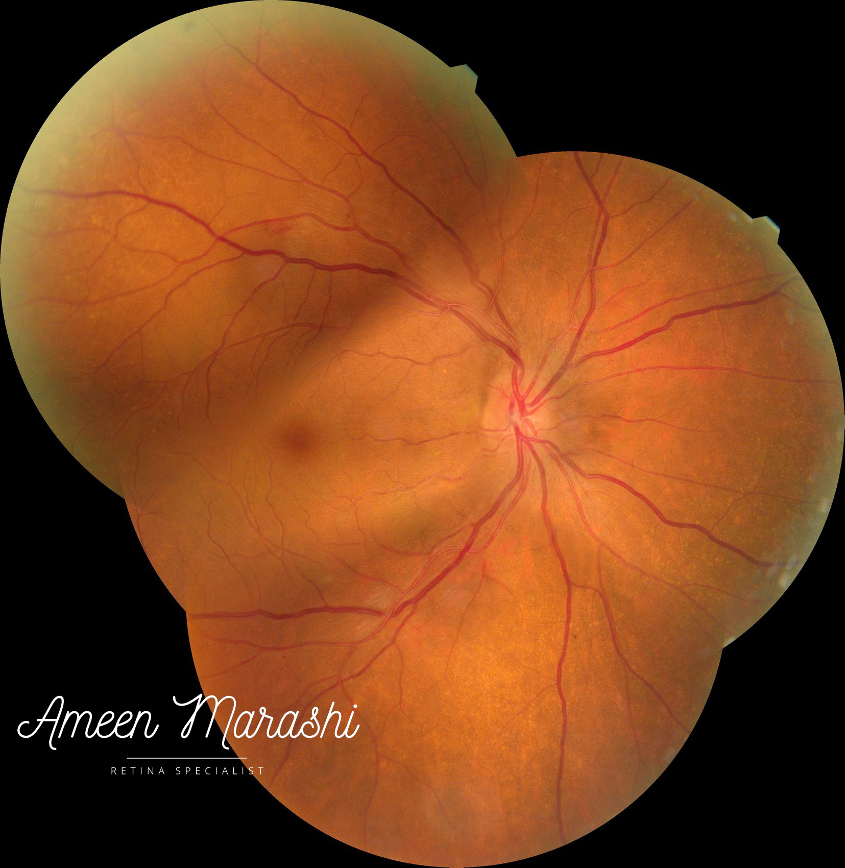 Choroidal metastasis
