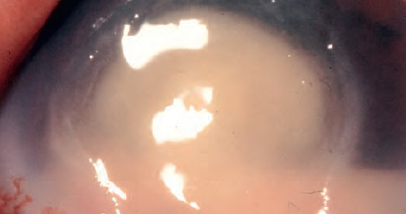 Bacterial corneal ulcer and its complication