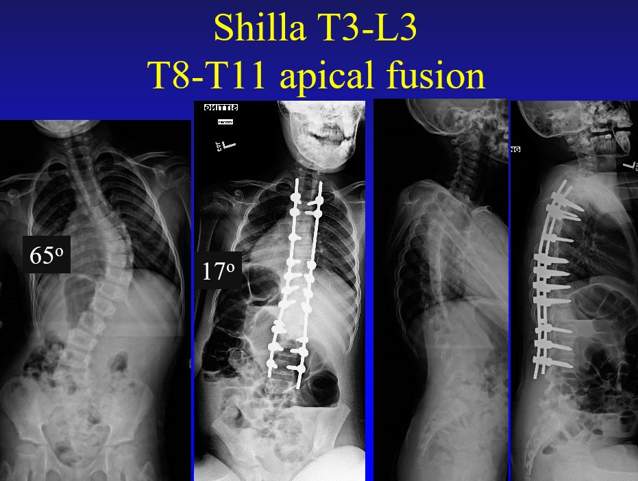 The Shilla Growth Guidance Procedure | Growing Spine Blog | Washington ...