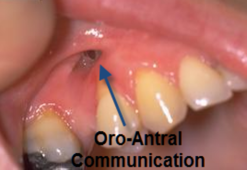 WizDent: Oro Antral Fistula
