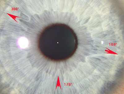Modern & Multidimensional Iridology: Scurf Rim, Brushfield's Spot ...