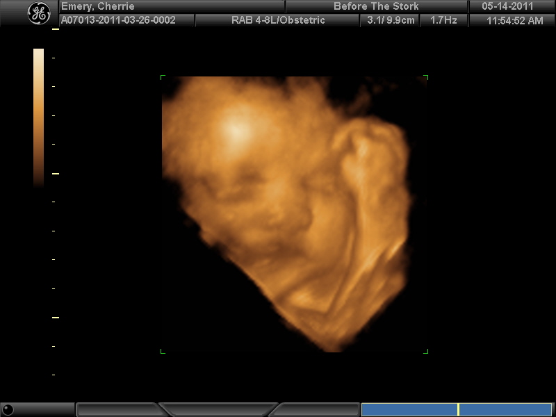 Making mEmerys: 3D/4D Ultrasound-30 Weeks