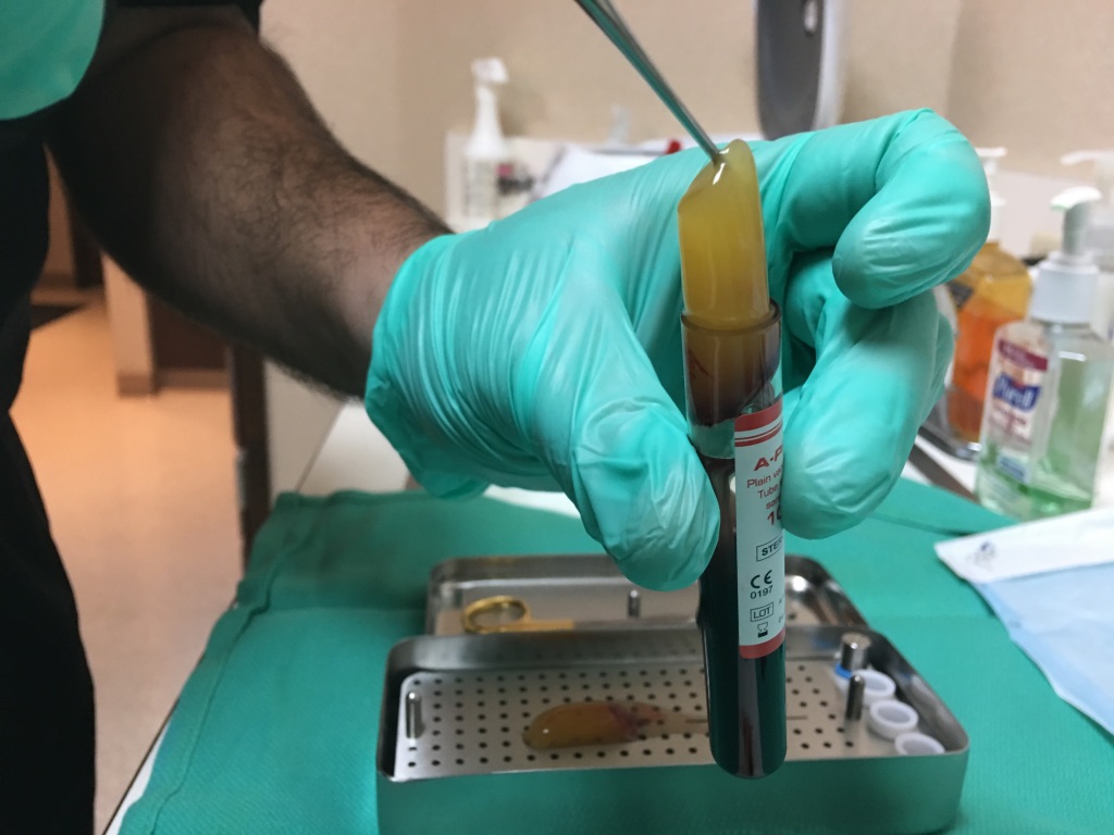 Dr Mogre Oral Facial Surgery Blog: Step by Step guide in preparation of ...