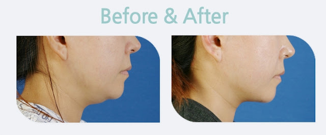 Jowl Chin Tuck Free Backgrounds | Lu Sih Kas