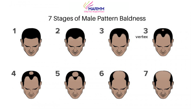 Male Pattern Baldness Stages And Treatments