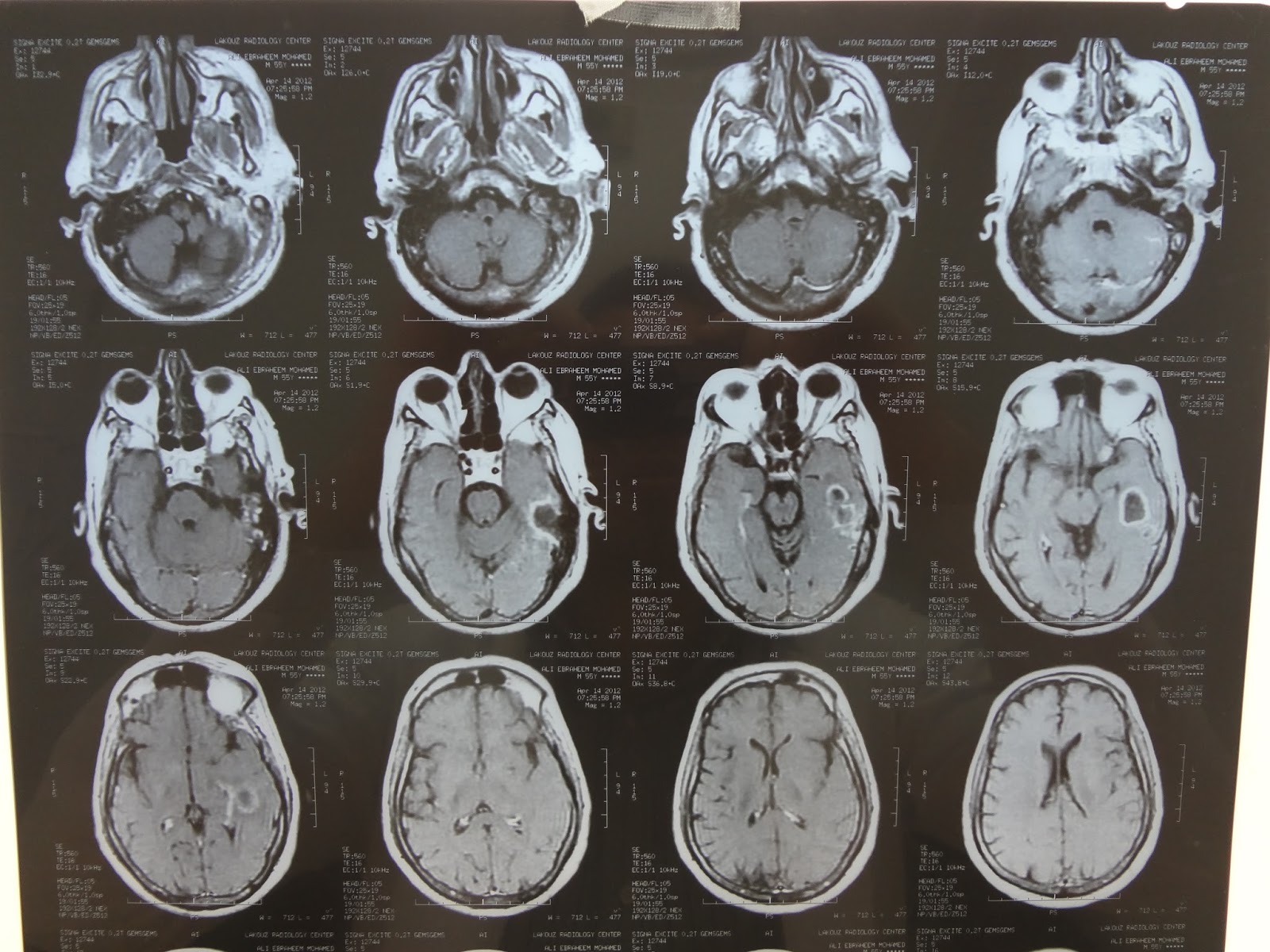 lt temporal lobe abscess complicating attico antral cholesteatoma MRI ...
