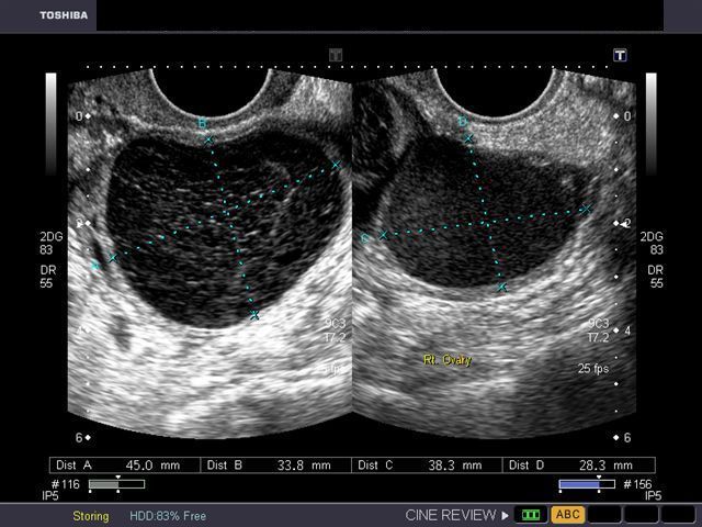 Medical Ultrasound Chocolate Cyst