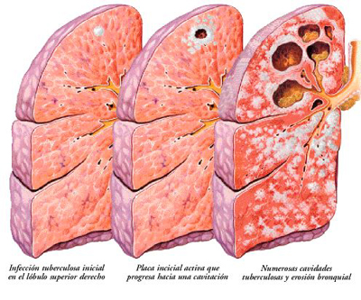 ENFERMEDADES INFECCIOSAS Y MICROBIOLOGIA MEDICA: TUBERCULOSIS-HISTORIA ...