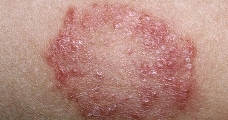 14+ Cara Mengobati Penyakit Ringworm Secara Alami