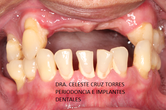 Introducción a la Periodoncia: agosto 2017