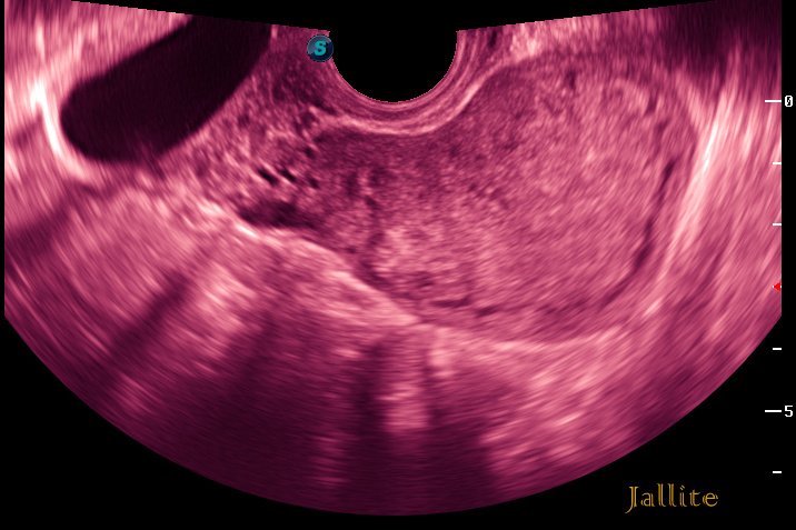 Quiste Naboth Gigante