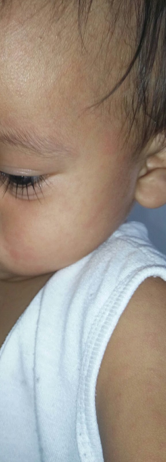 Tigdas hangin (German measles) sa sanggol.