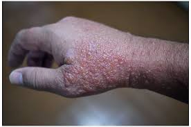 Control de Plagas en Sanidad Ambiental: Fitofotodermatitis