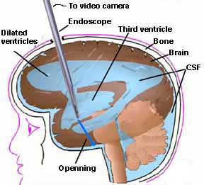 Hydrocephalus Surgery by Dr. Saurabh Garge at Sukriti Clinic