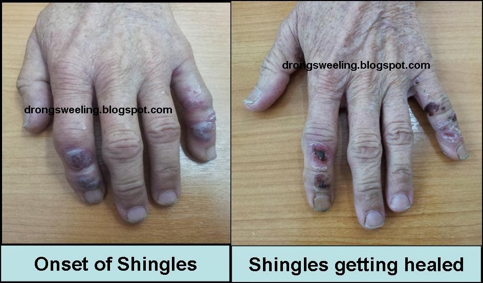 TCM News: TCM Physician Cure Shingles (Herpes Zoster), Postherpetic ...