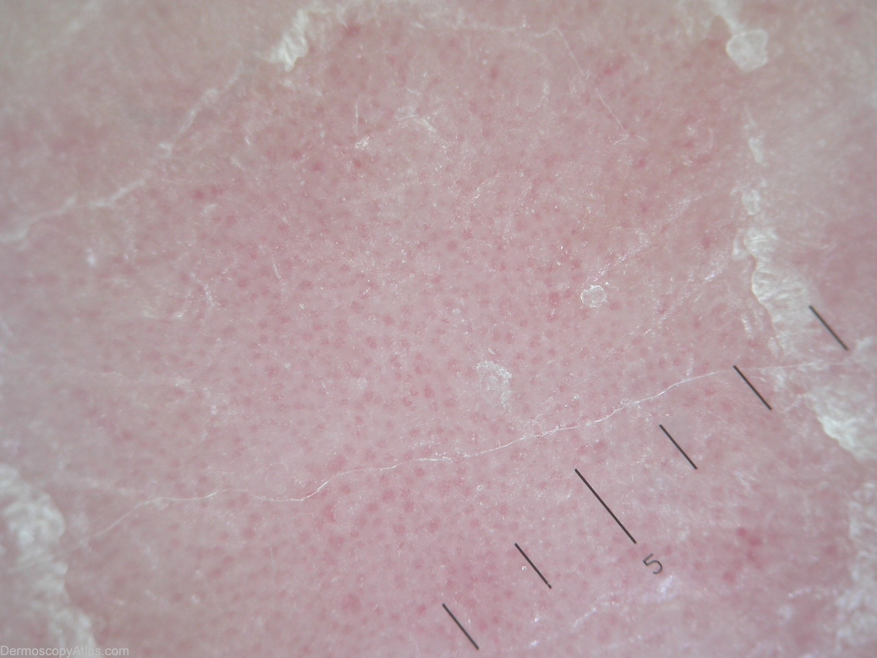 Dermoscopy Features as Clues: Dots Red