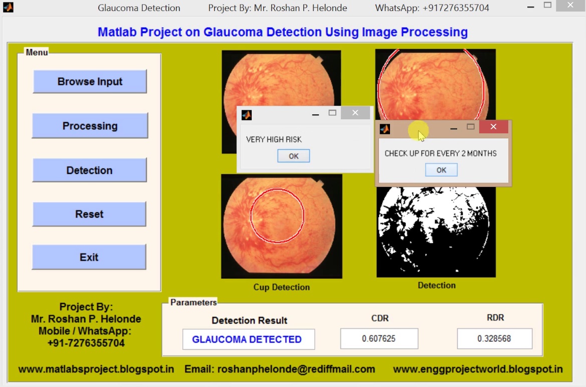 Glaucoma Detection Using Image Processing Matlab Project With Source Code ~ Matlab Project Codes