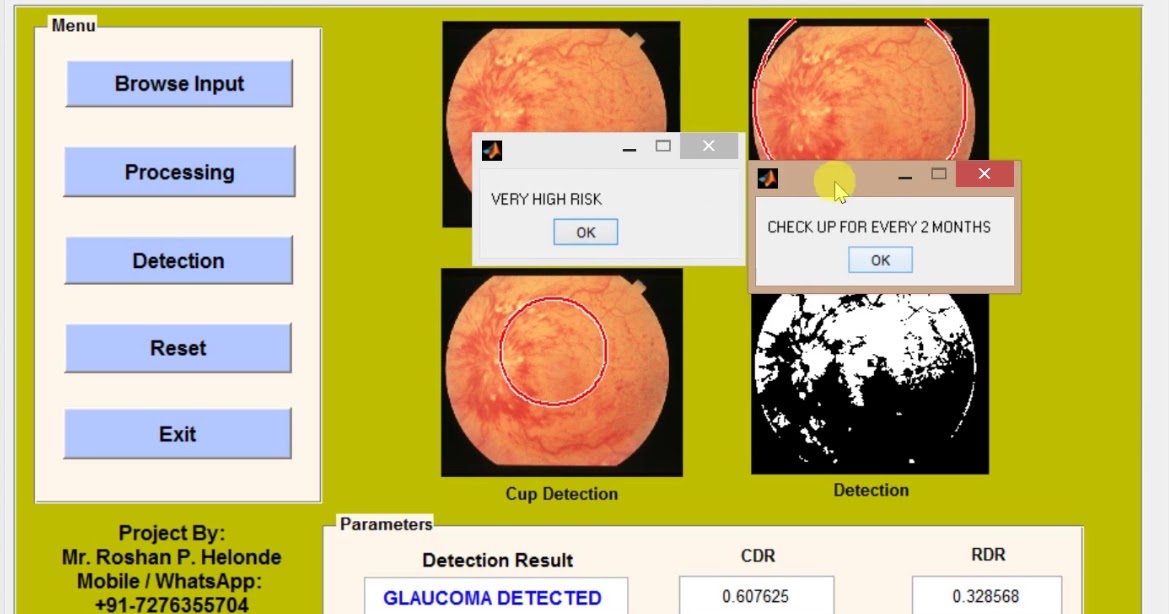 Glaucoma Detection Using Image Processing Matlab Project With Source Code ~ Matlab Project Codes