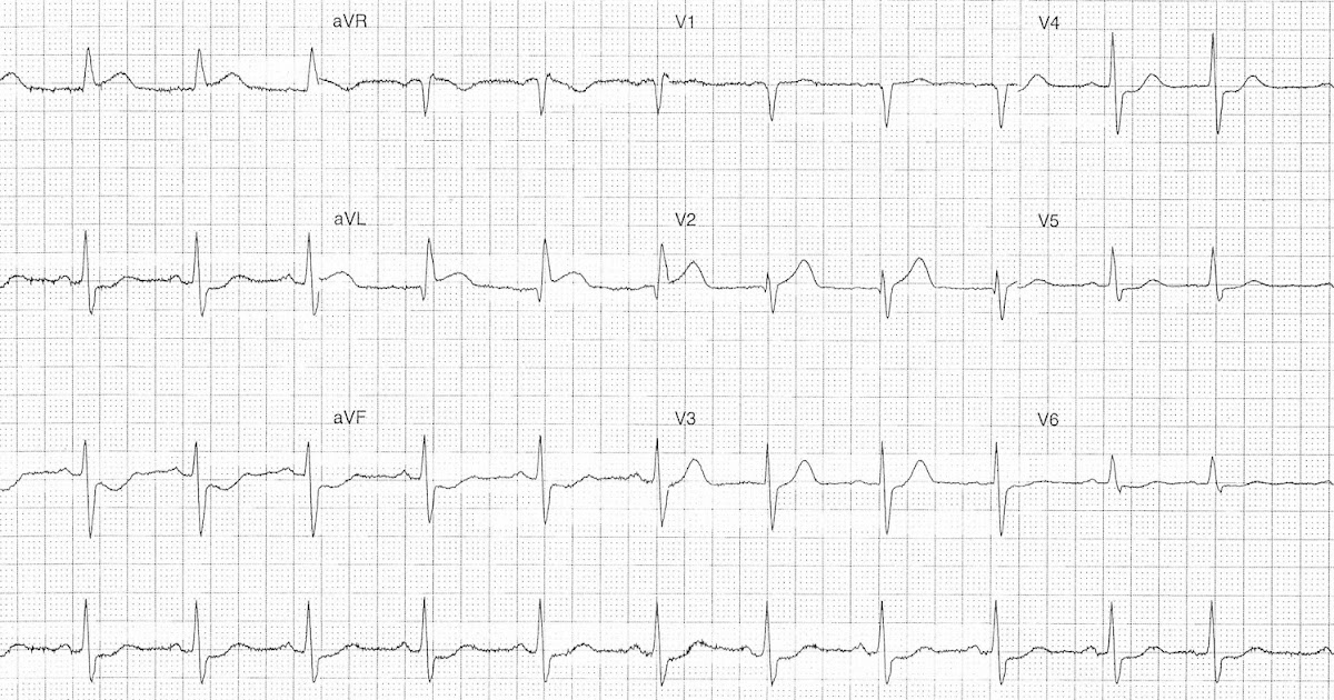 ECG of the Week: ECG of the Week - 7th November 2016 - Interpretation