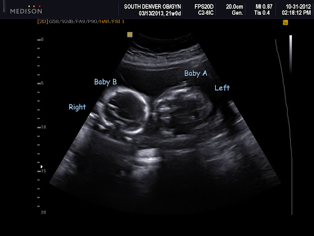 A Road Well Traveled: Anatomy Scan- 21 weeks!