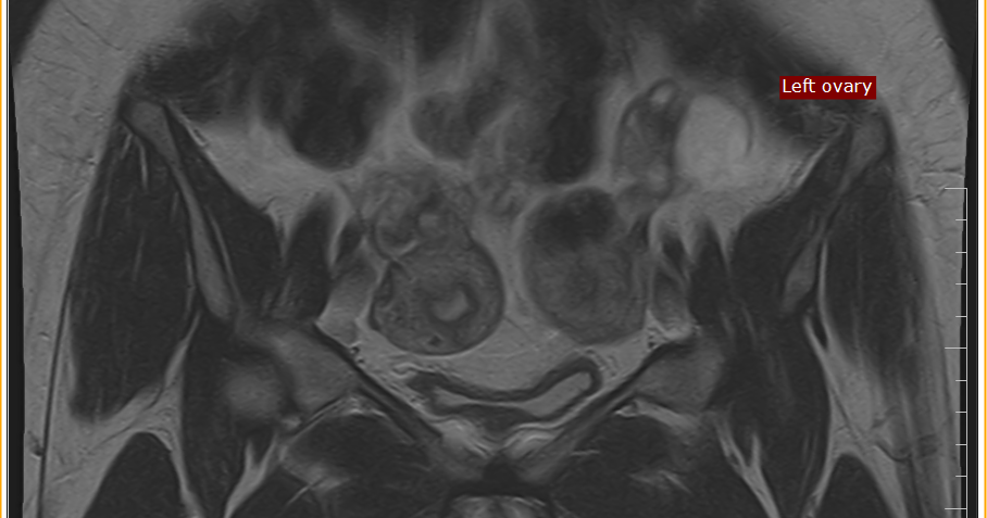 Bicornuate Uterus: MRI - Sumer's Radiology Blog