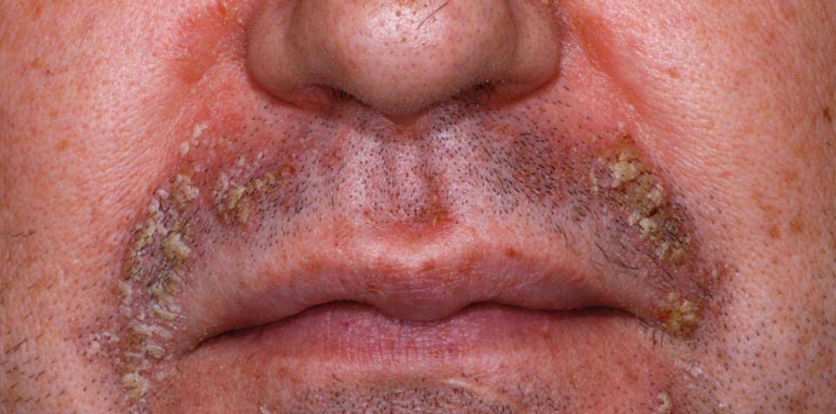 Kostrelaterade sjukdomar. Gluten, mjölk, besvär och följdsjukdomar ...