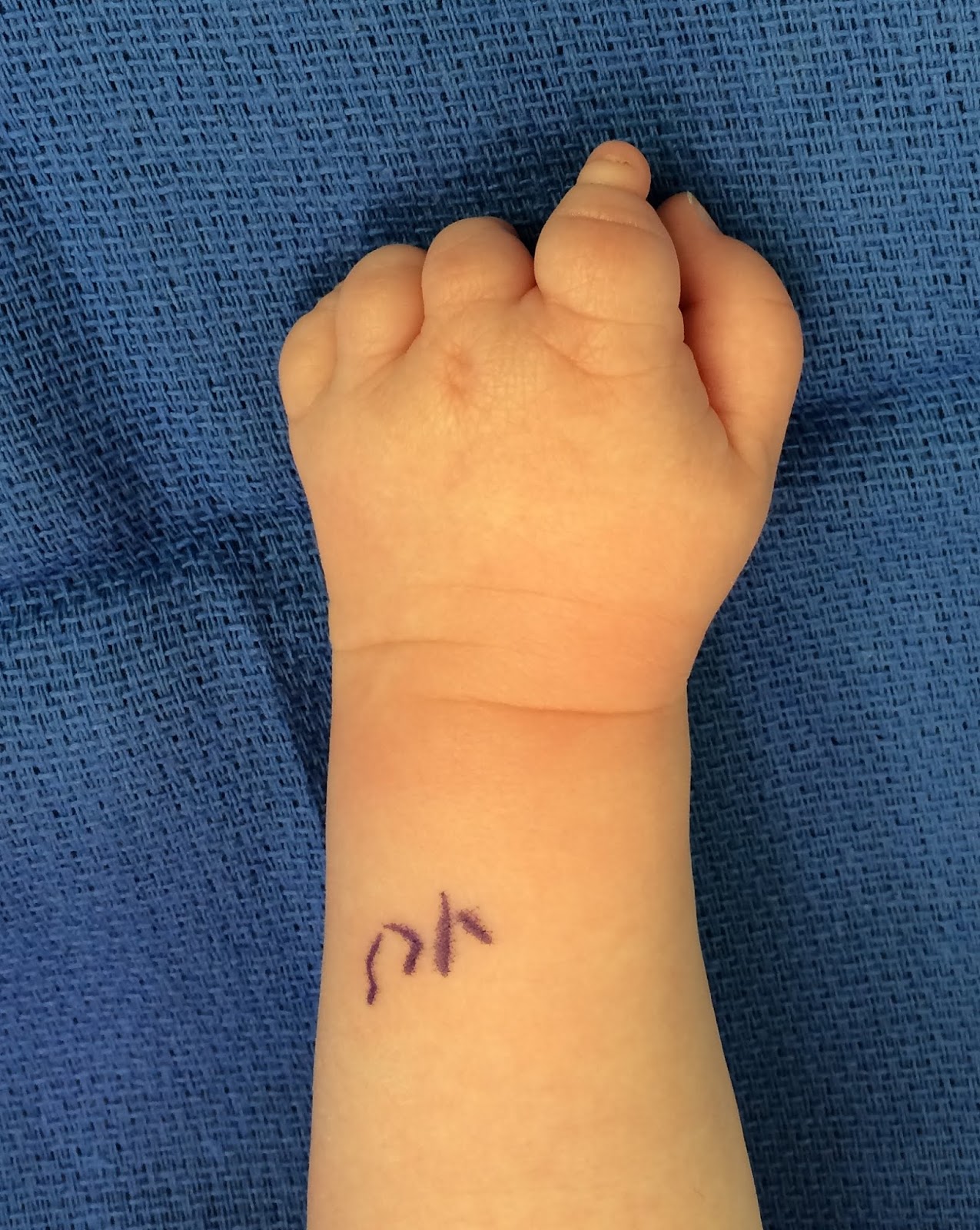 Only a thumb. Amazing outcome! | Congenital Hand and Arm Differences ...