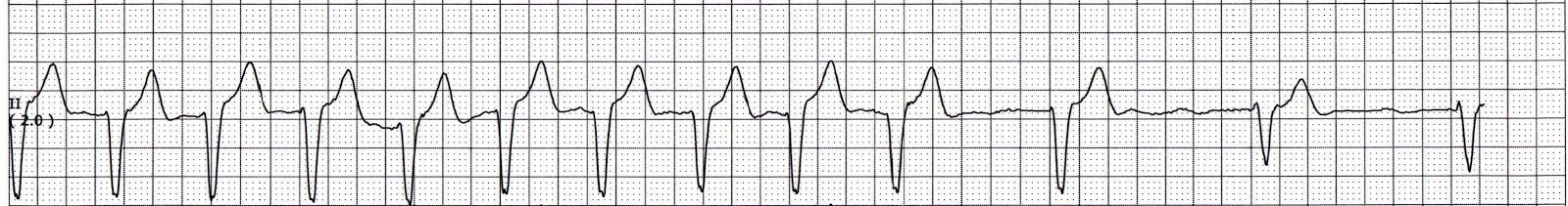 ECG Rhythms: The "skipping" P waves