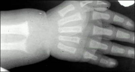 Prepare for Medical Exams : Approach To A Child With Rickets