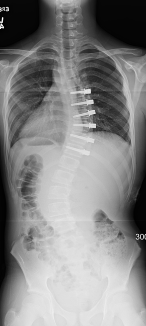 Vertebral Body Tethering for Scoliosis | Growing Spine Blog ...