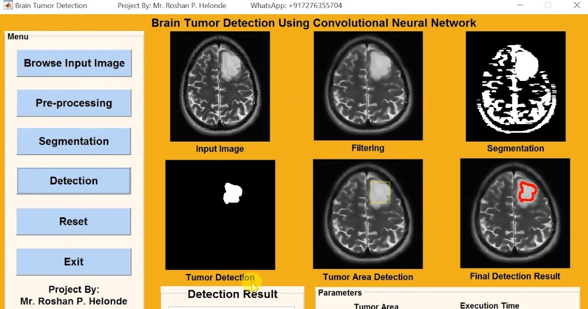 Matlab Code for Brain Tumor Detection Using CNN (Convolutional Neural ...