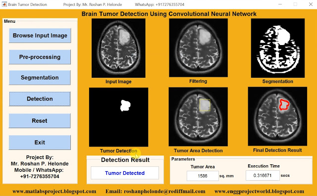 Matlab Code For Brain Tumor Detection Using Cnn Convolutional Neural Network Matlab Project