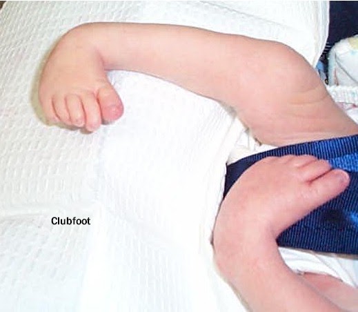 CTEV (Congenital Talipes Equinovarus) or Clubfoot | Treatment Zone