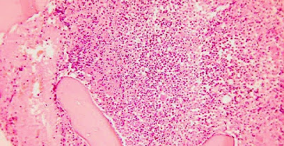 HEMATOLOGIA: MIELOFIBROSIS PRIMARIA