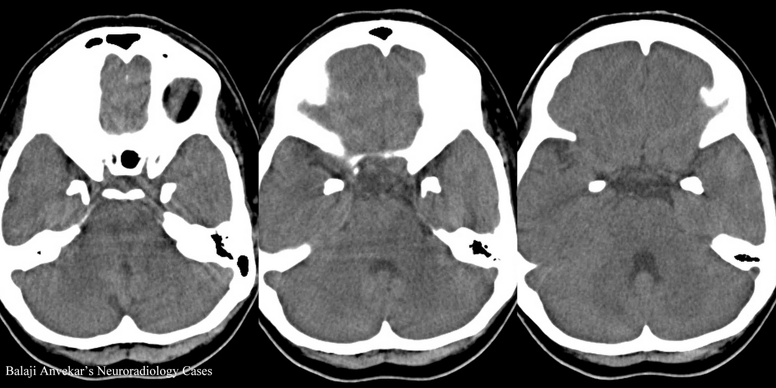 Dr Balaji Anvekar FRCR: Lipoid Proteinosis