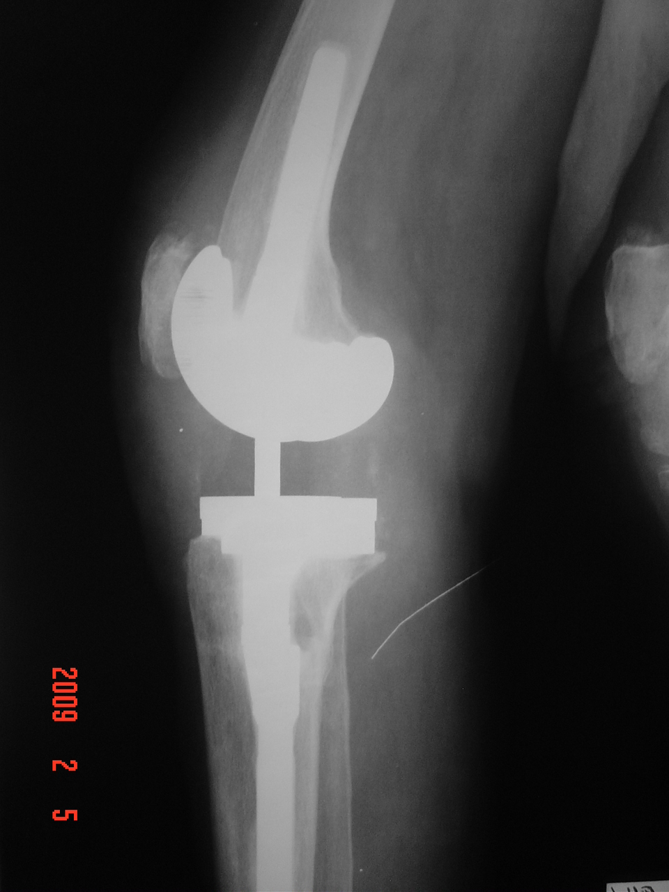 OSSA CARPALIA ©: ARTROPLASTIA TOTAL DE RODILLA DE REVISIÓN