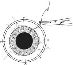 Ophthalmology Notes: SPOTS & DOTS in Ophthalmology