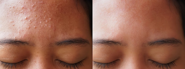 Problemas de acne? Confira esta lista de dicas úteis!