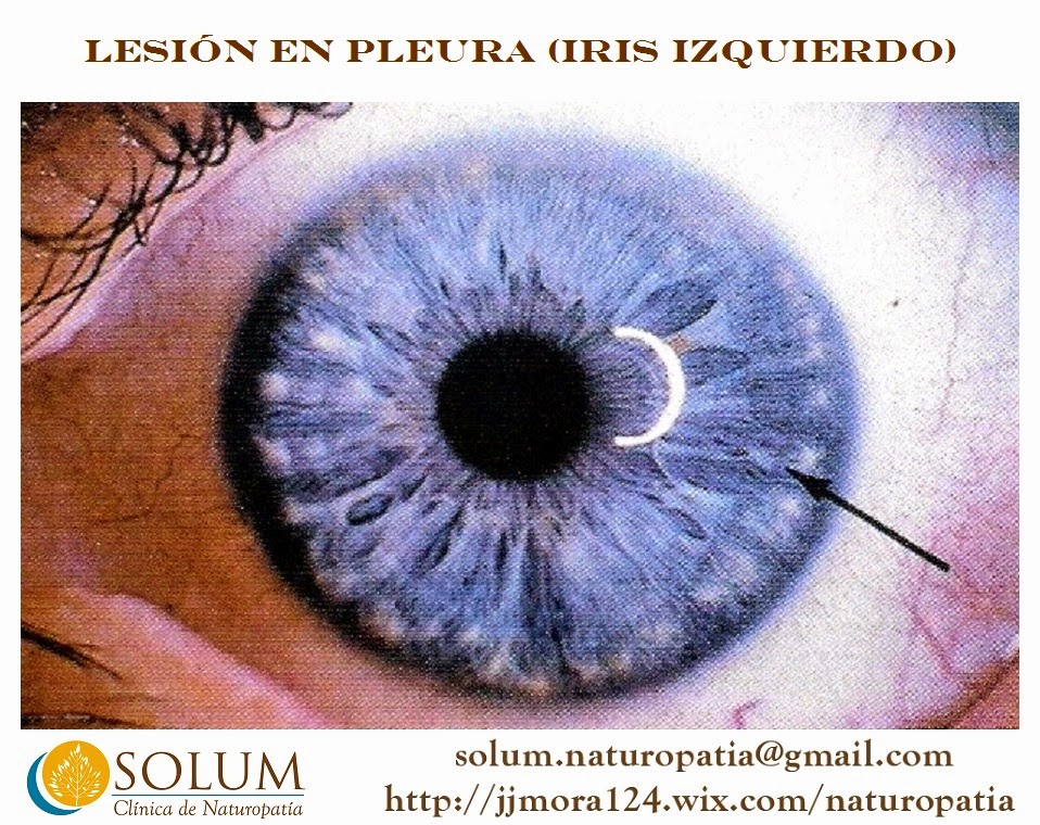 Enfermedades vistas a través del Iris.