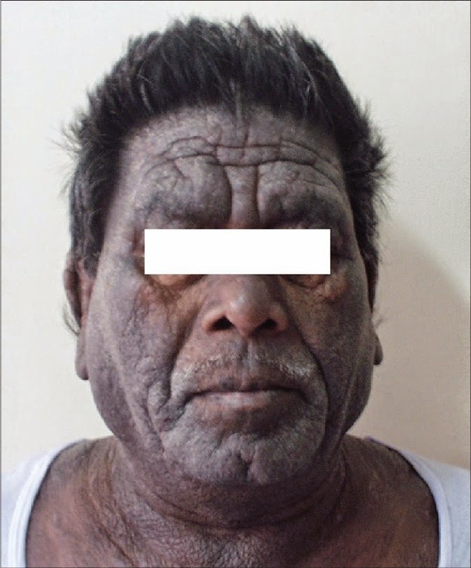 Teledermatology for PG entrance: Air Borne contact dermatitis (ABCD)