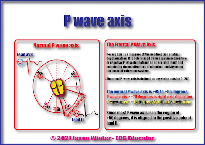 ECG Educator Blog : P axis on an ECG