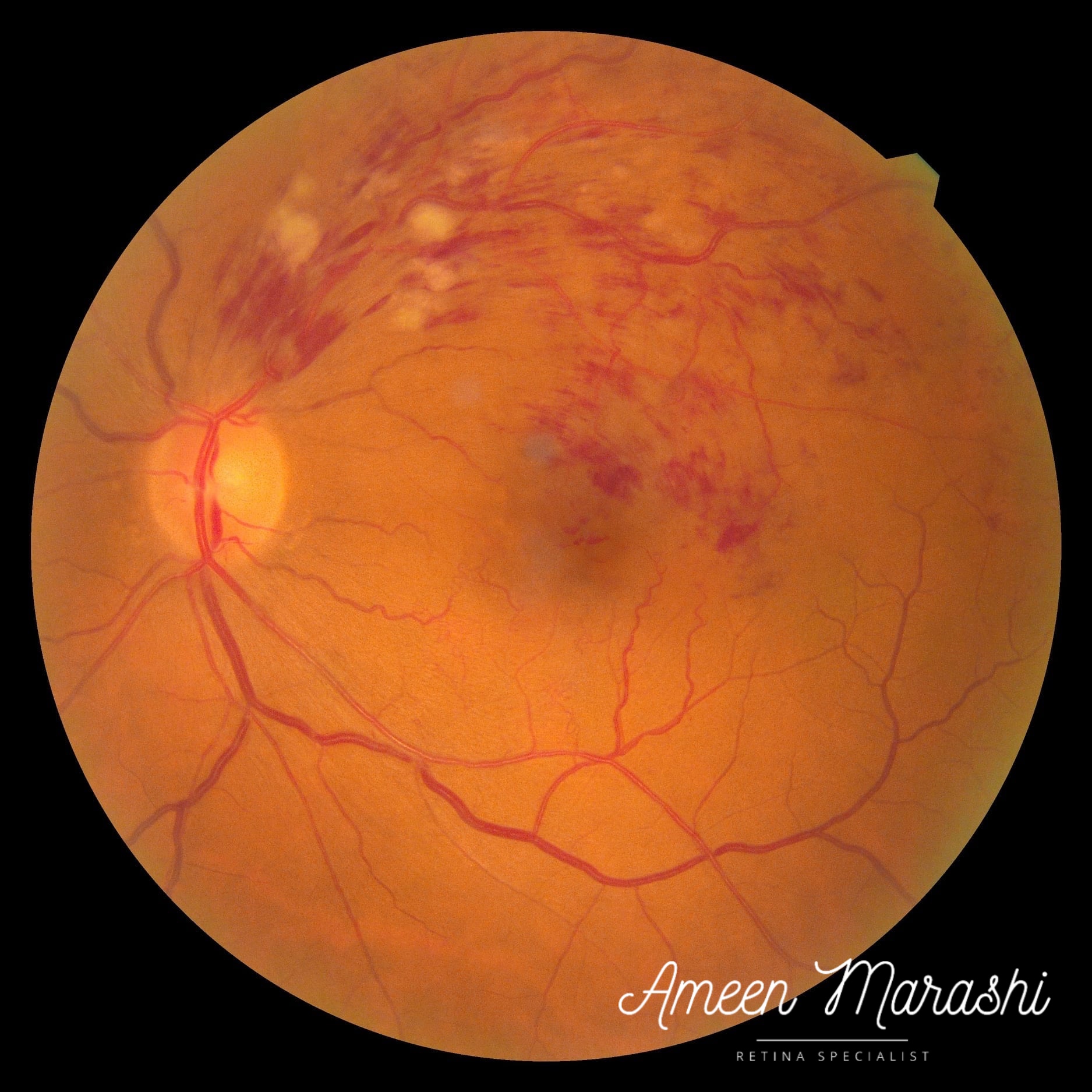 Branch retinal vein occlusion case presentation
