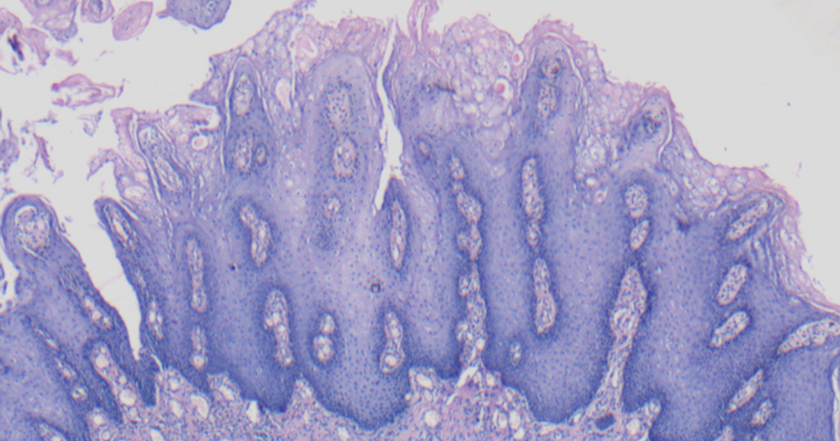into the roots: Condyloma acuminatum
