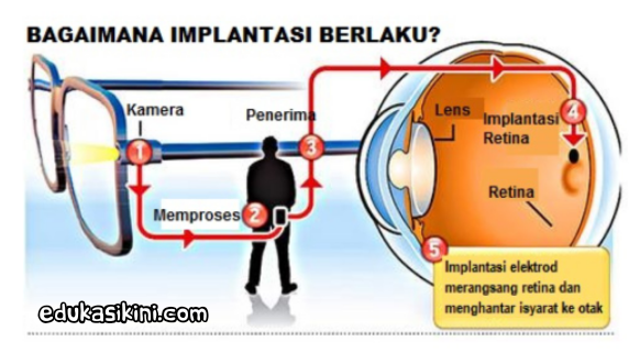 Mata Bionik Penglihatan Untuk Orang Buta - EDUKASIKINI.COM