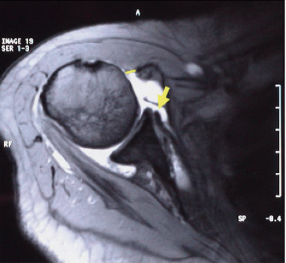 UW Shoulder and Elbow Academy: "Coracoid impingement" - is this ...