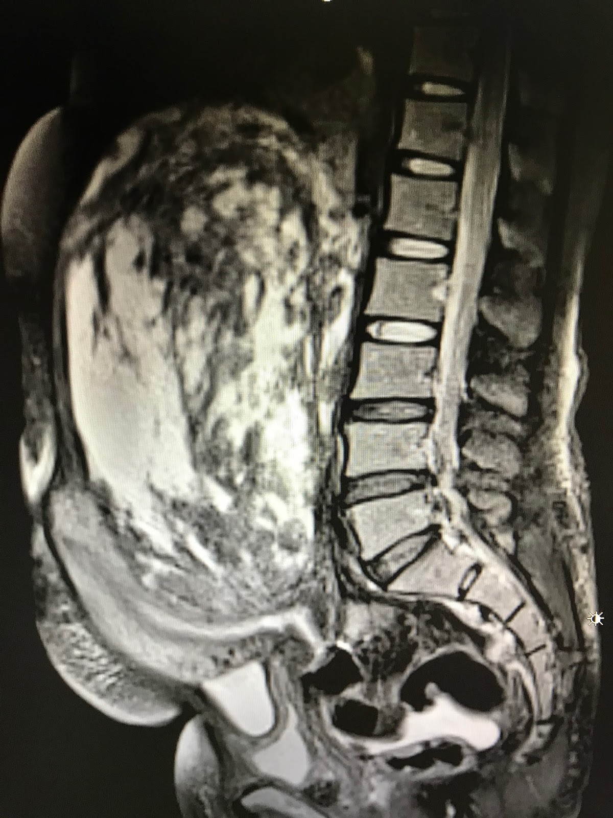 VIETNAMESE MEDIC ULTRASOUND: CASE 483: UTERINE GIANT MYOMA, Dr PHAN ...