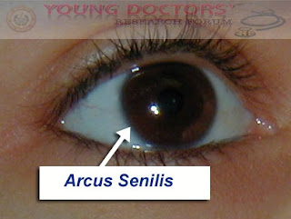 Photos For Arcus Senilis ~ YOUNG DOCTORS' RESEARCH FORUM