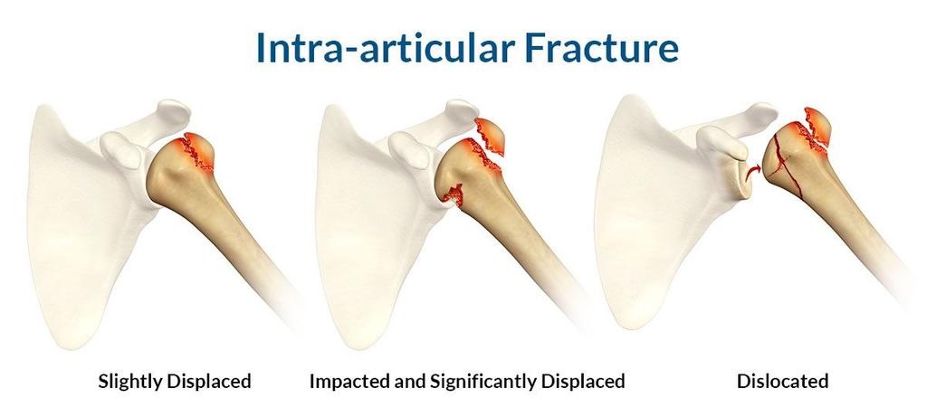 Intraarticular Fractures - Diagnosis and Treatment ~ Information Guide ...