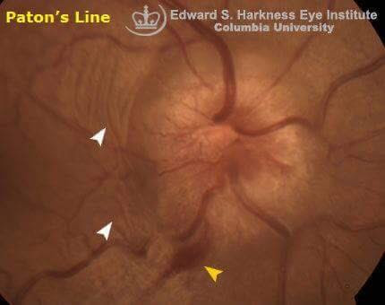 Ophthalmology Notes: Lines in Ophthalmology