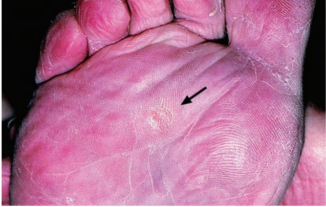 Corns and Calluses - Clinical Presentation & Differential Diagnosis